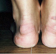 Heel Pump Bump Haglunds Deformity